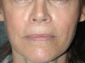 Botox | Best Botox Injections New York City