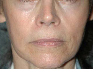 Botox | Best Botox Injections New York City