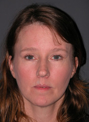 Endoscopic Mid Facelift | Endoscopic Mini Face Lift