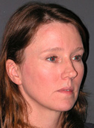 Endoscopic Mid Facelift | Endoscopic Mini Face Lift