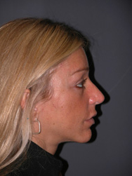 Endoscopic Mid Facelift | Endoscopic Mini Face Lift