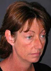 Endoscopic Mid Facelift | Endoscopic Mini Face Lift