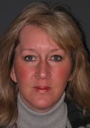 Endoscopic Mid Facelift | Endoscopic Mini Face Lift