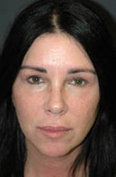 Endoscopic Mid Facelift | Endoscopic Mini Face Lift