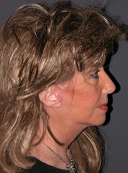 Facelift Photos | Before and After Facelift Pictures
