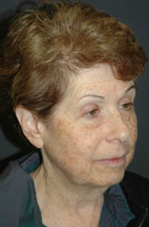 Mini Facelift Before & After Photos | Dr. Andrew Jacono