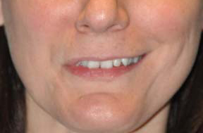 Facial Paralysis Surgery | Facial Reanimation New York