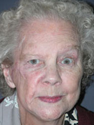 Facial Paralysis Surgery | Facial Reanimation New York