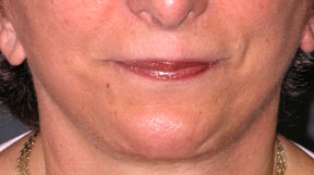 Revision Facelift Photos | Before & After Revision Facelift