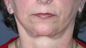Revision Facelift Photos | Before & After Revision Facelift