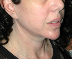Revision Facelift Photos | Before & After Revision Facelift