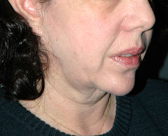 Revision Facelift Photos | Before & After Revision Facelift