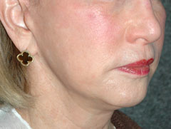 Revision Facelift Photos | Before & After Revision Facelift