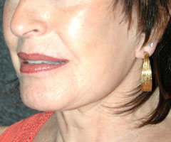 Revision Facelift Photos | Before & After Revision Facelift