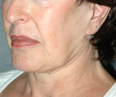 Revision Facelift Photos | Before & After Revision Facelift